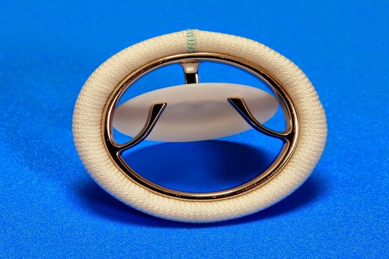 Chitra heart valve: Upgraded Chitra heart valve implanted in 40 patients..